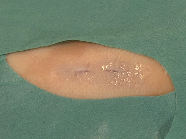 Wundkleber günstig online kaufen | MaskMedicare